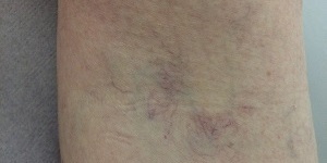 CMVC | Varices, symptômes de la maladie veineuse chronique